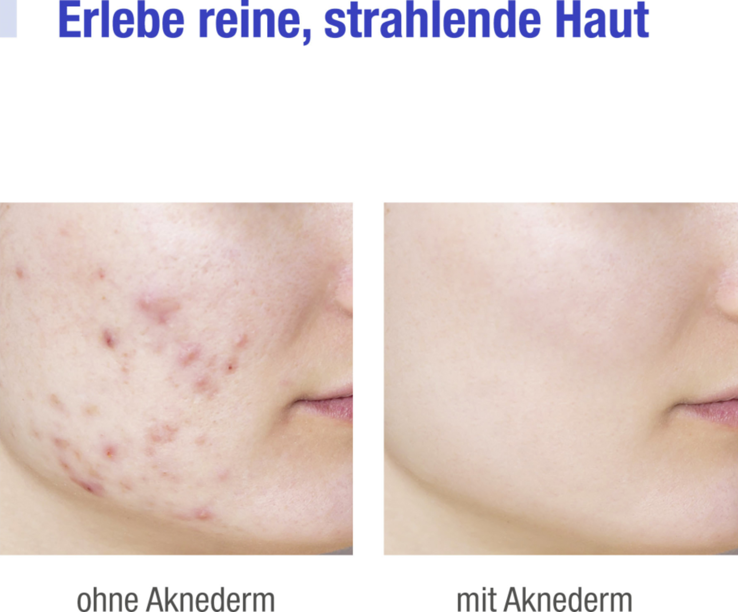 Aknederm Creme til behandling af urenheder Køb online | rossmann.dk